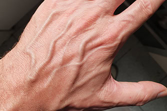 Restore Smooth Hands with Hand Vein Treatment Today