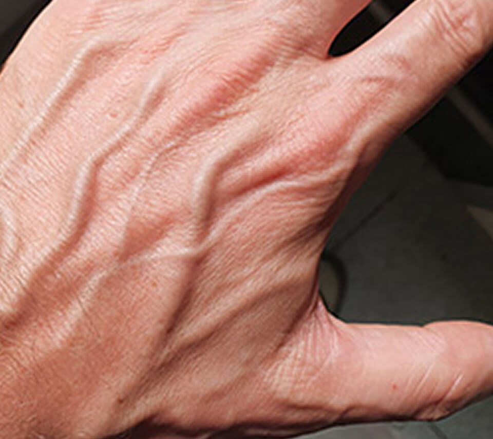 Hand Vein Treatment in Florida – Youthful Hands Again